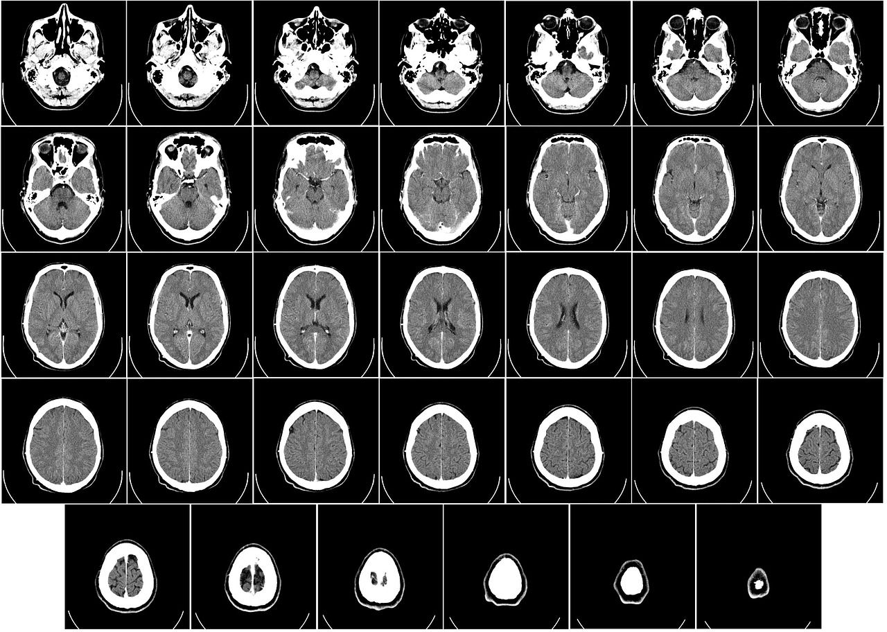 Warwick Researchers Solve The Schizophrenia Test That Stumped Them All 